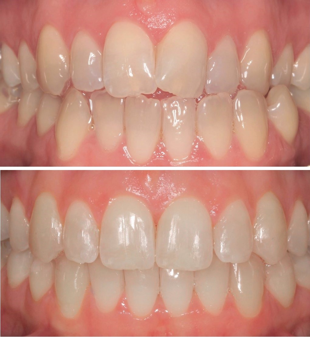 Before & After | Whites Dental Care